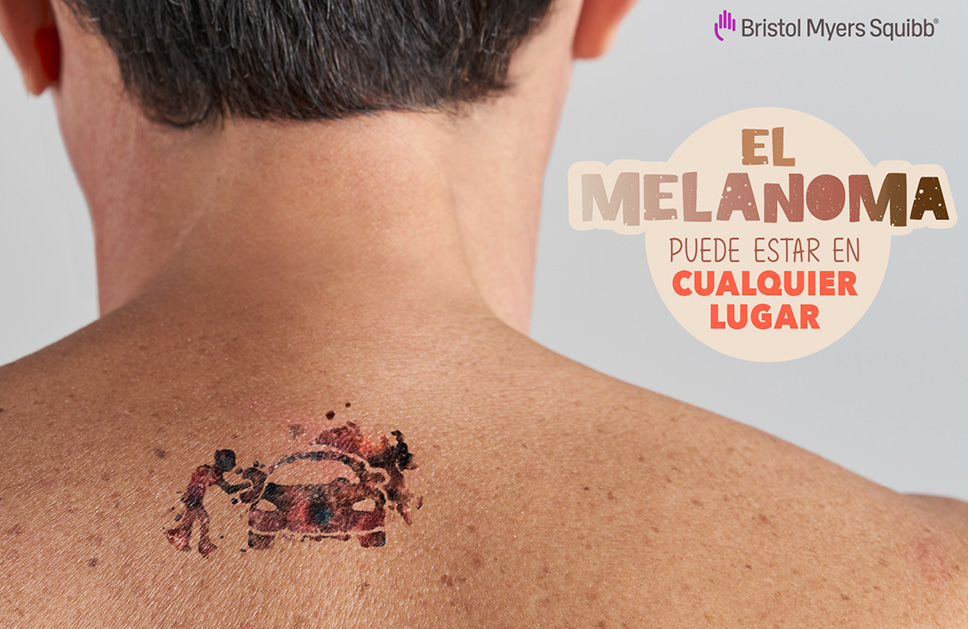 ¿QUÉ ES EL MELANOMA?